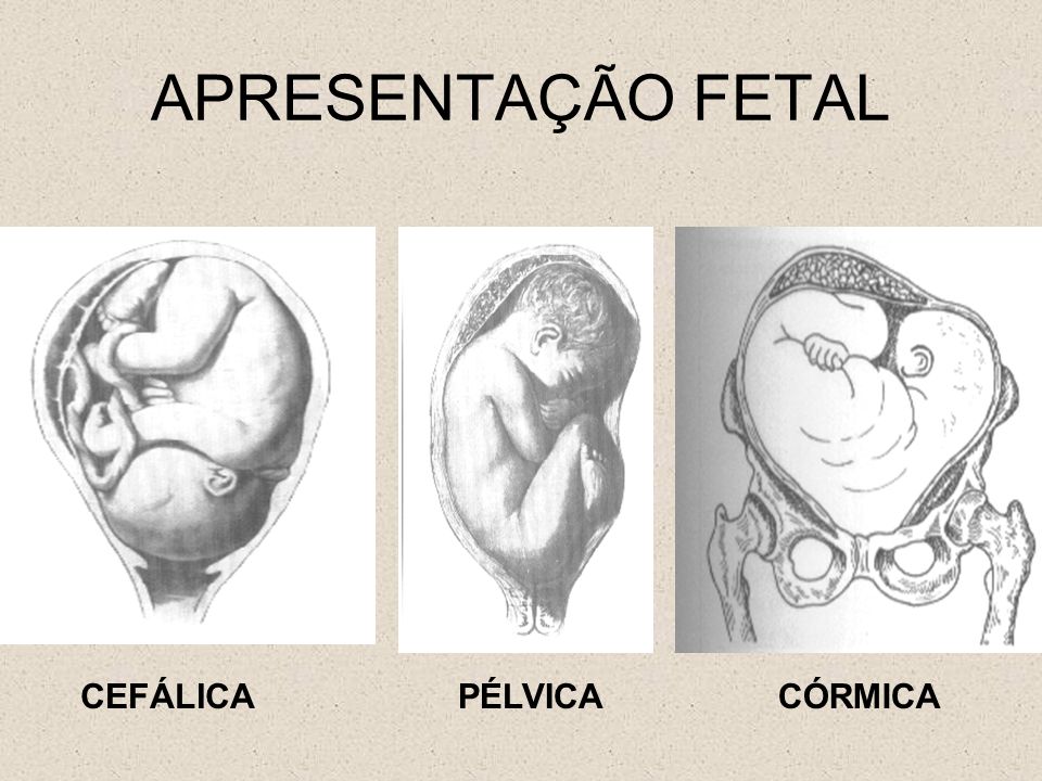 O Que Significa Feto único Em Situação Longitudinal Apresentação ...