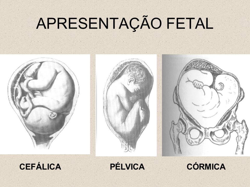 Apresentação Pelvica Com Dorso A Esquerda - RETOEDU